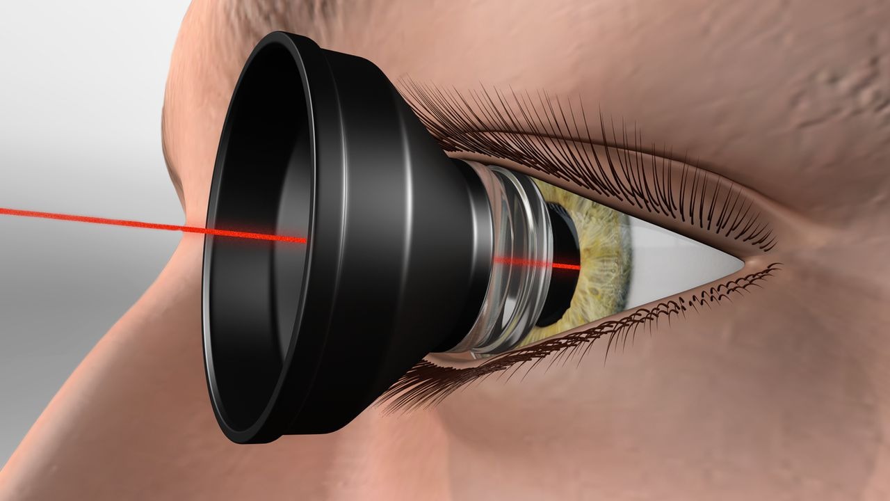 TERMAL (ARGON) LAZER FOTOKOAGÜLASYON – Adana Retina